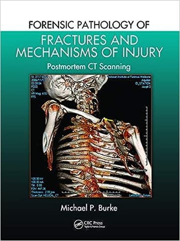 Forensic Pathology Of Fractures And Mechanisms Of Injury Postmortem Ct ...