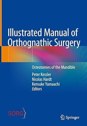 Illustrated Manual Of Orthognathic Surgery Osteotomies Of The Mandible ...