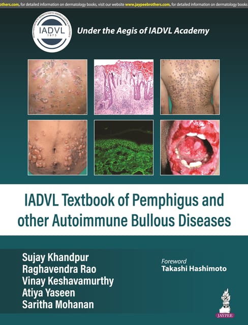 Iadvl Textbook Of Pemphigus And Other Autoimmune Bullous Diseases 2024 ...